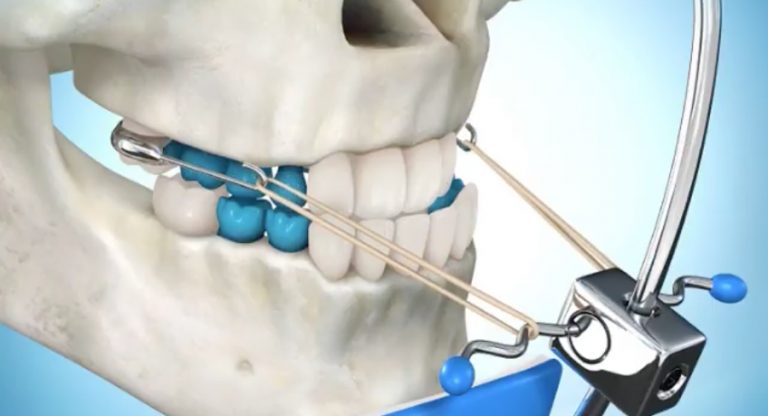 Máscara facial ortodôntica: tudo que você precisa saber - Codental Blog