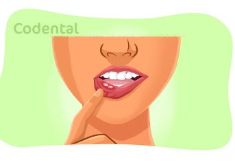 Afta na gengiva: tudo que você precisa saber!