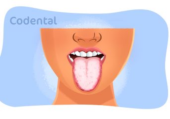 Saburra lingual: saiba tudo sobre!