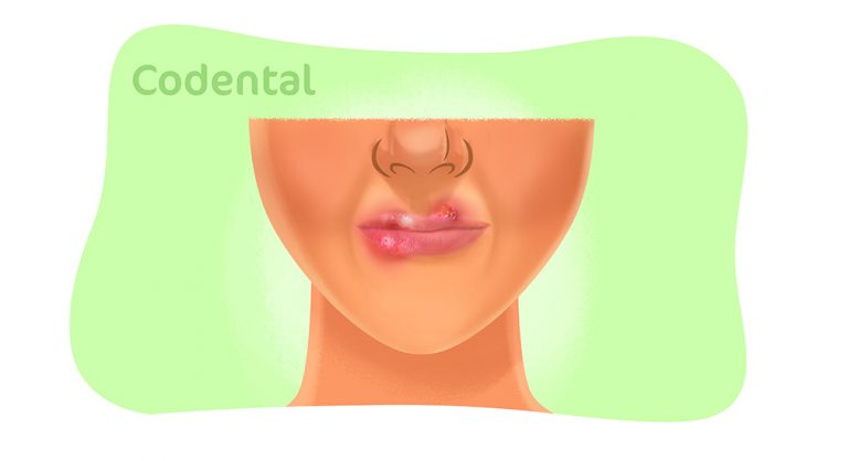 Herpes labial: causas, sintomas e tratamento