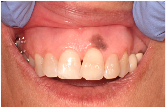 Mácula melanótica: tudo que você precisa saber!