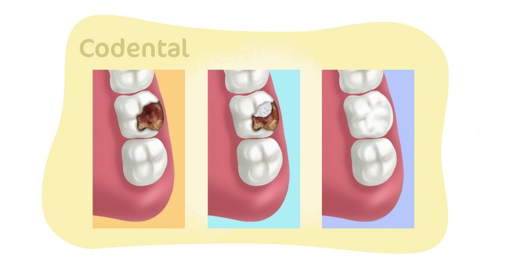 Abfração dental: um guia completo sobre esse problema!